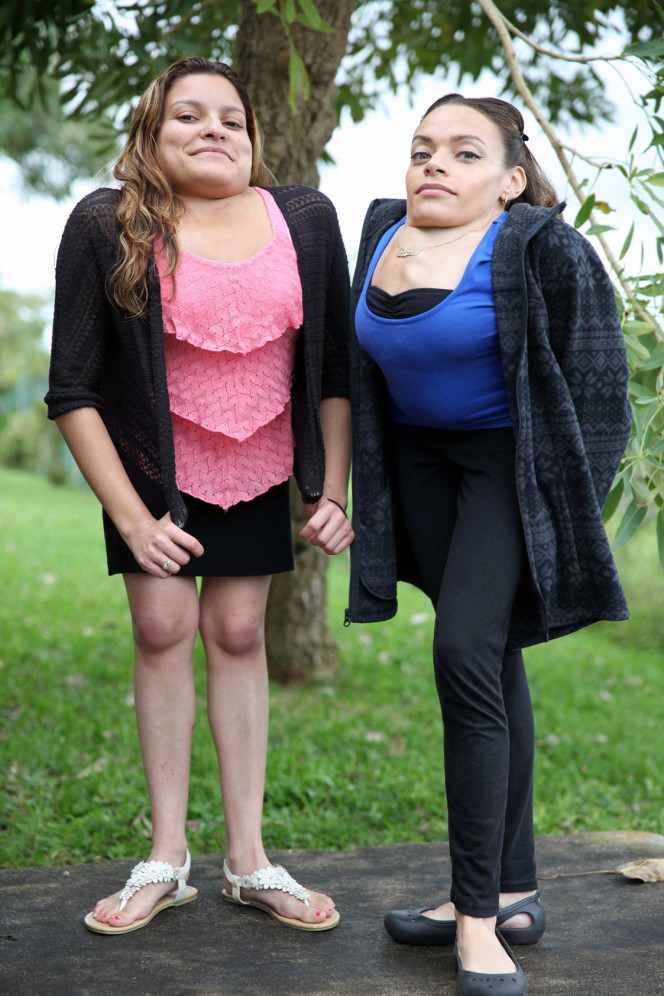 Jarcho-Levin Syndrome Patients Meet for First Time in New TLC Program ...