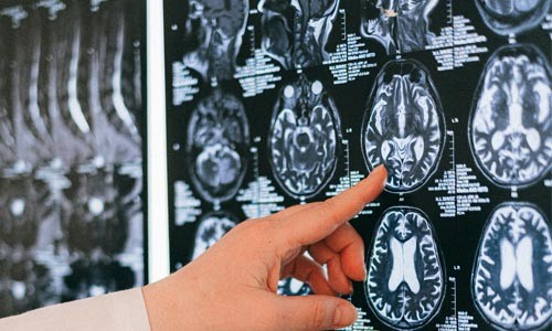 Helixmith Reports Positive Topline Results from Phase 2A Study of ALS ...