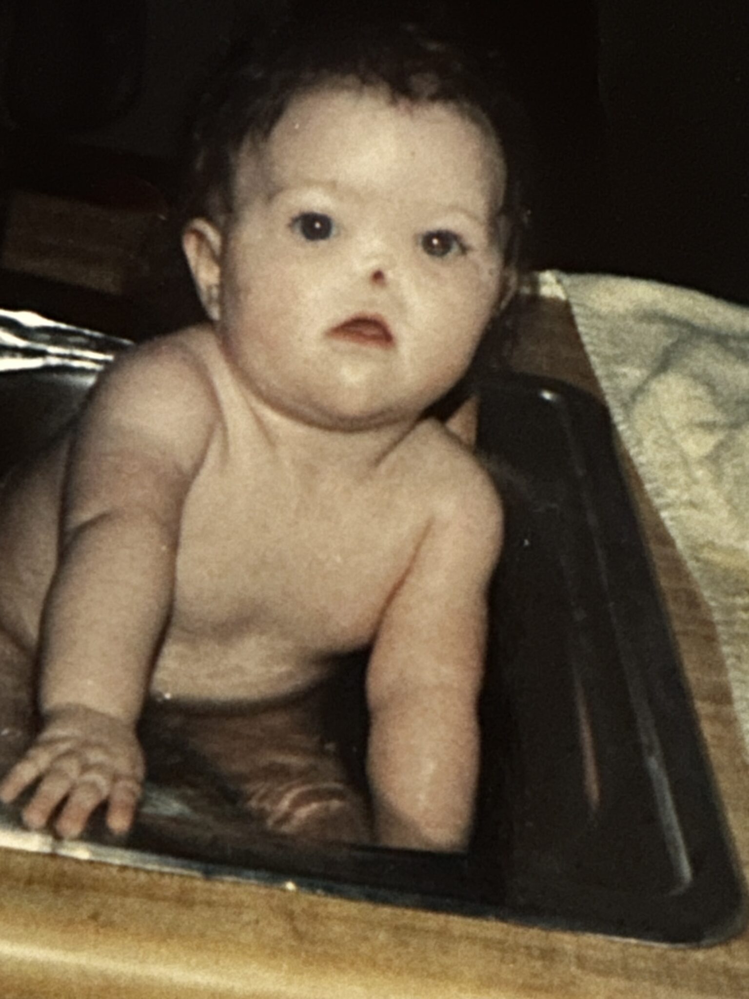 Born without a Nose - Congenital Arhinia - Global Genes