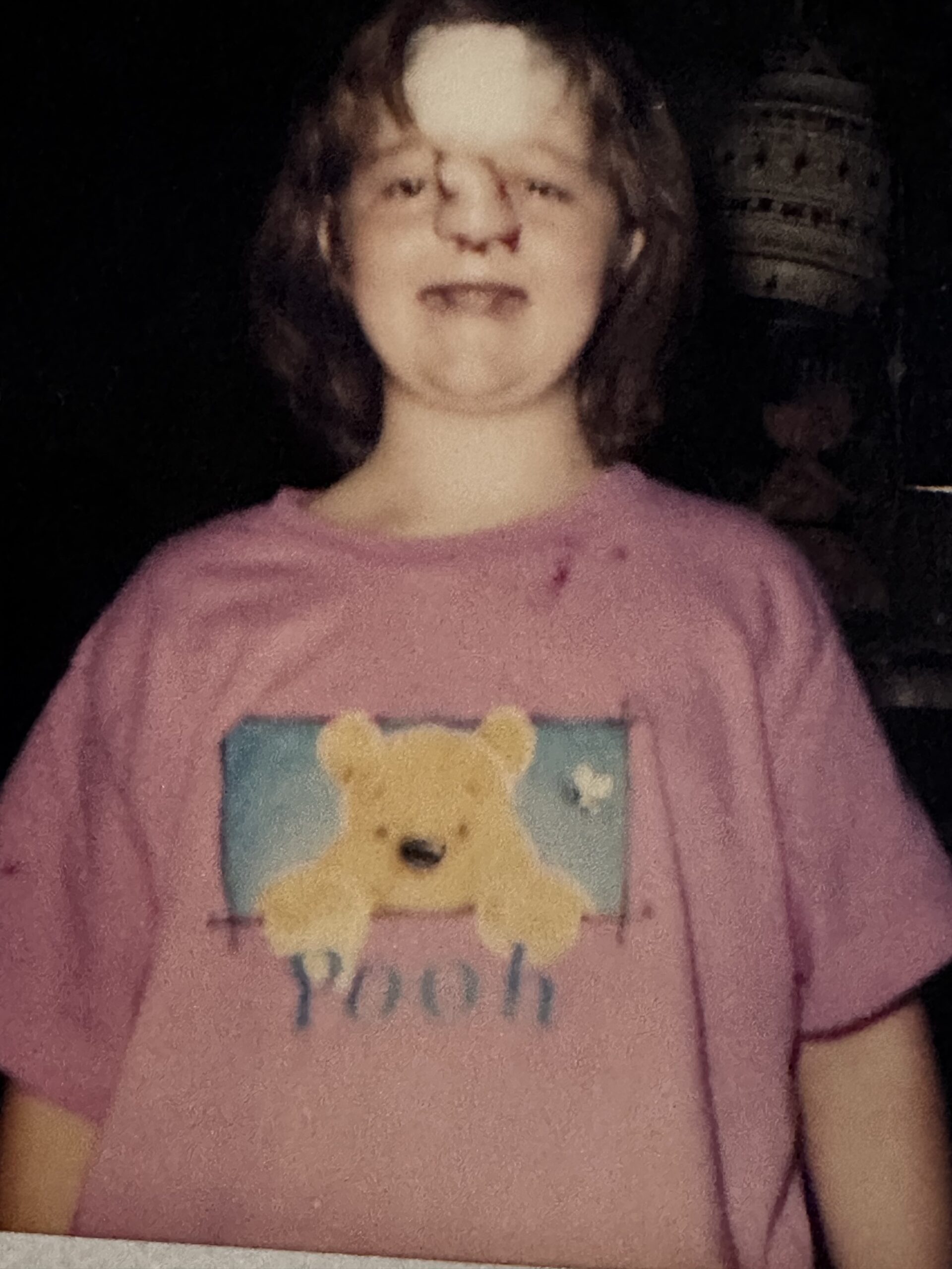 Born without a Nose - Congenital Arhinia - Global Genes